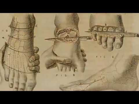 U.S. Civil War Amputations
