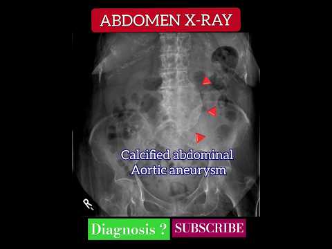 Calcified abdominal aortic aneurysm - X Ray Abdomen - Radiology