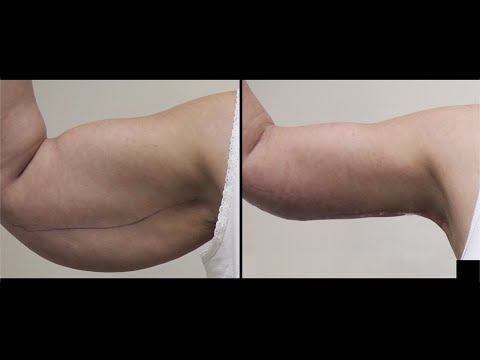 Dr. Joseph J. Castellano | Before & After Video: Arm Lift Case #114