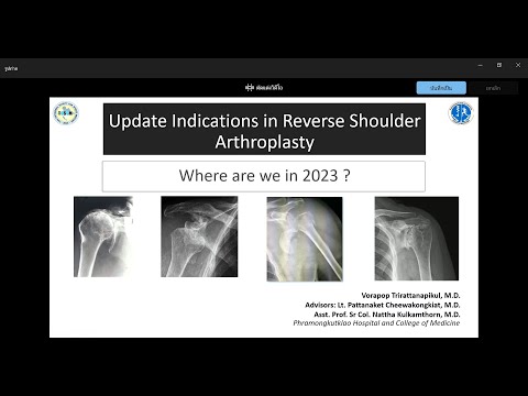 Update indication in Reverse Shoulder Arthroplasty : Where we are in 2023?