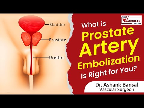 The Future of Prostate Treatment | Prostate Artery Embolization Explained | Dr. Ashank Bansal