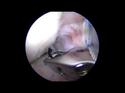 Incisionless Knee Synovectomy and Biopsy With Needle Arthroscope and Autologous Tissue Collector