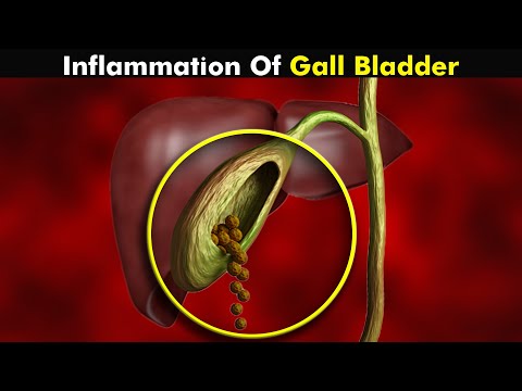 Cholecystitis (Gallbladder Inflammation) | Symptoms, Causes and Treatment (Urdu/Hindi)