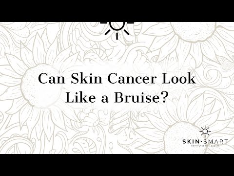 Can skin cancer look like a bruise?