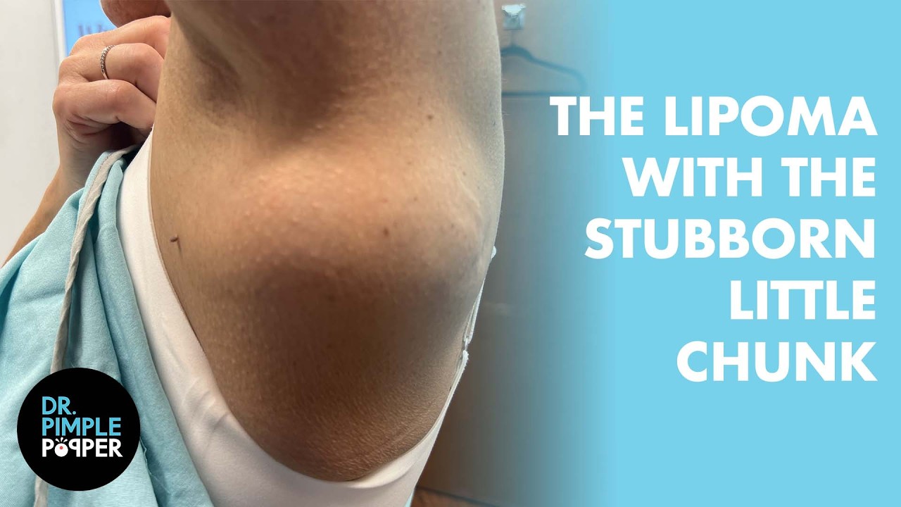 The Lipoma With The Stubborn Little Chunk | Dr. Pimple Popper