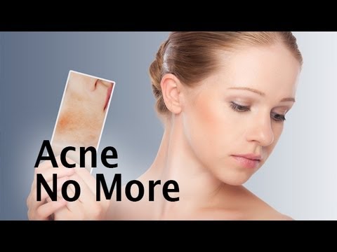 No More Acne | No More Acne