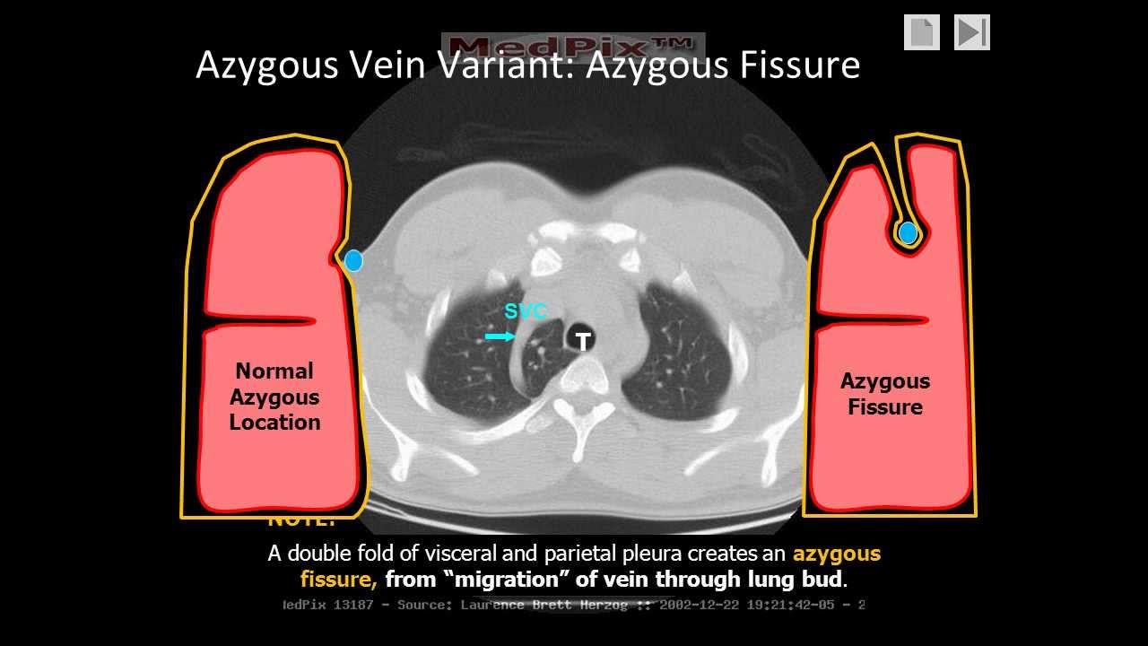 Chest Radiology: The Azygous Fissure, a normal variant