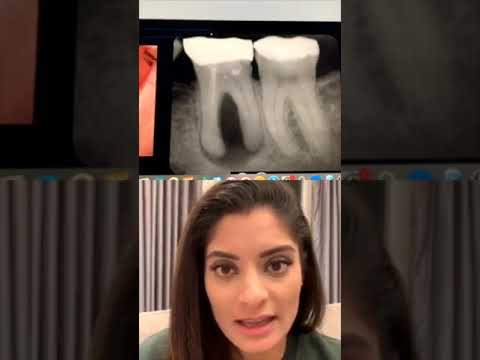 Endodontic Retreatment with Kreena Patel
