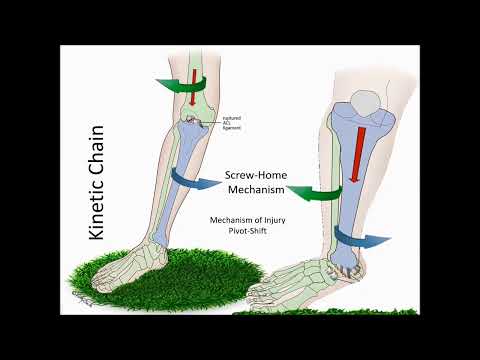 Ankle Syndesmosis Injury Management with POLICE | Enovis Webinar