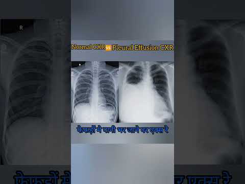 Diffrence between Normal Chest X ray &Pleural effusion #medicalimaging #xray #radiology