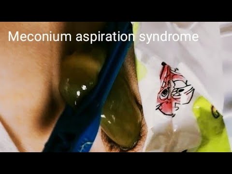 Meconium Aspiration Syndrome | Pediatrics