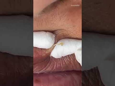 How lip blackheads are extracted #blackheaads #skincare #skin #selfcare