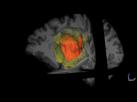ICH Imaging: Hemorrhagic Stroke in Acute Phase