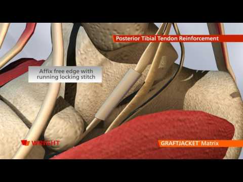 Posterior Tibial Tendon Reinforcement with GRAFTJACKET™ Regenerative Tissue Matrix