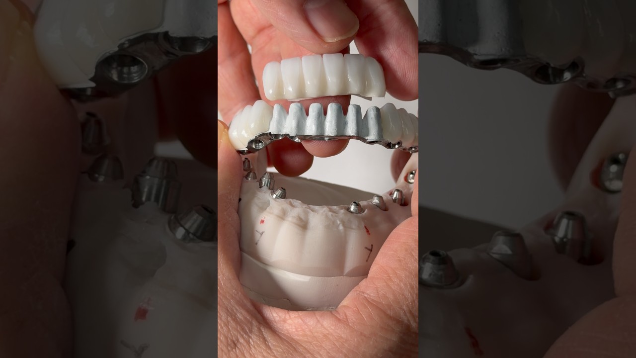 Another SYTON solution for a full-arch patient with a lot of implants