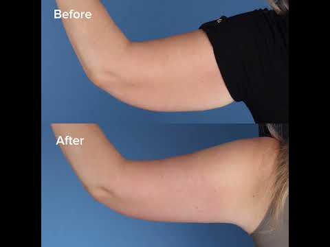 Before and After of an Arm Lift