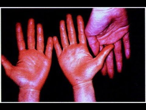 Vitamin A Toxicity Symptoms