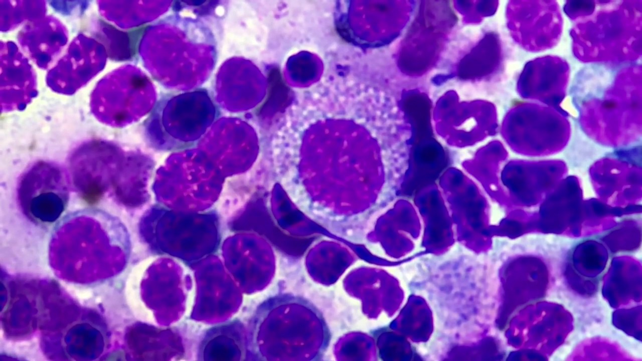 Promyelocyte in bone marrow cytology