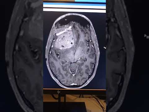 MRI brain 🧠large mass lesion #mri #like #share #beginners #planning #viral #viralshorts #study