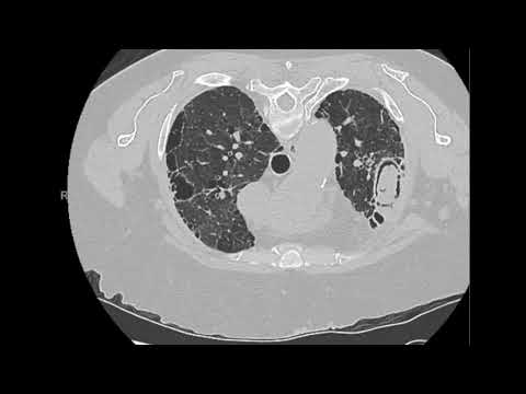 Mycetoma in UIP on chest CT (HRCT)