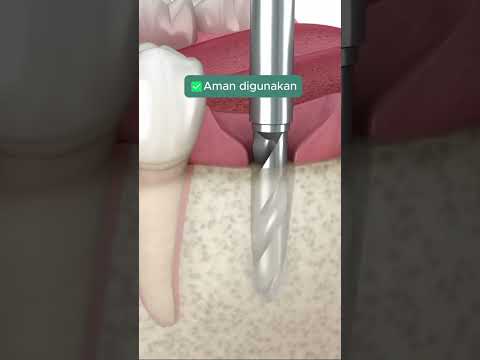 Akar implan gigi bukan terbuat dari baja ya! Yuk simak penjelasannya