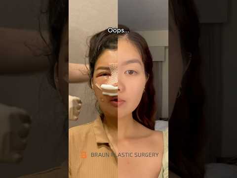 I become an AI after surgery!!😱😱 #fyp #glowup #rhinoplasty #beforeandafter