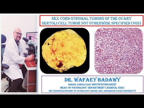 SEX CORD STROMAL TUMORS OF THE OVARY, SERTOLI CELL TUMOR NOS BY DR WAFAEY BADAWY