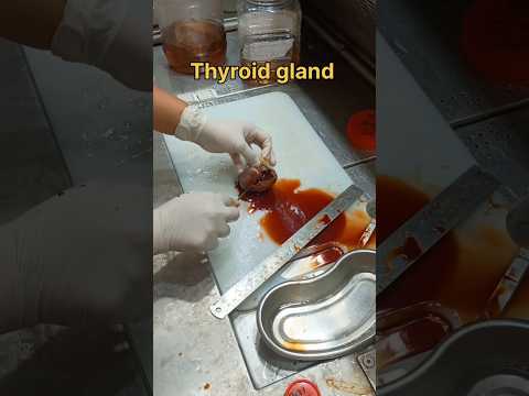 Cystic thyroid gland gross pathology