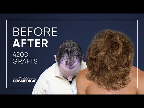 Hair Transplant in Turkey | Results | Dr. Acar | Cosmedica Clinic