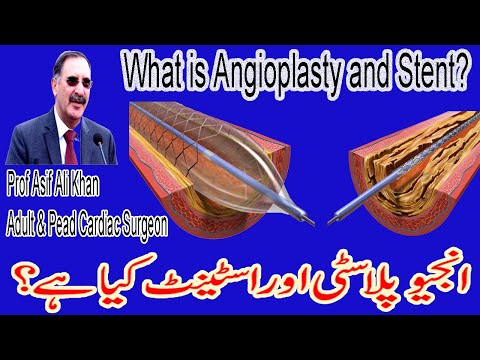 Angioplasty aur Stent kia hai in Urdu - Hindi