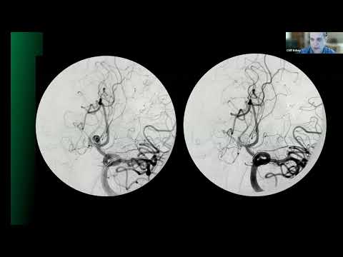 Dr Eskey treatment of AVM and aneurysms HD 1080p