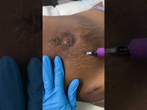 Stretch Marks Inkless Removal Boleyn Treatment Los Angeles  ???? #shorts