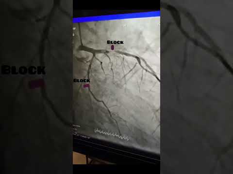 Left anterior descending (LAD) 90% blockage and left circumflex (LCX) 80% blockage