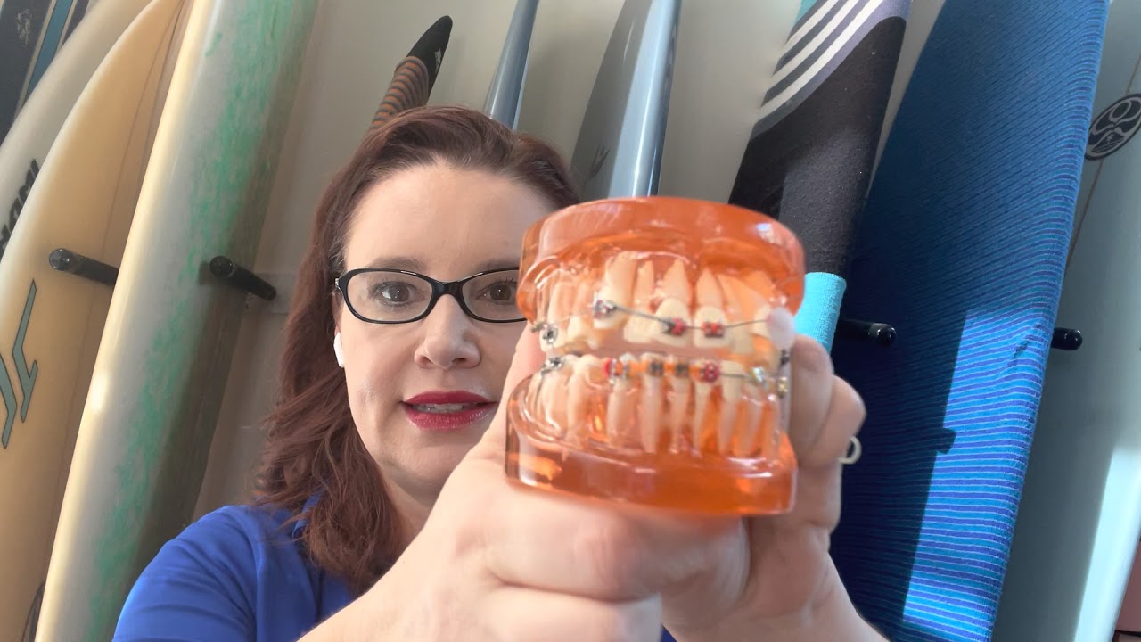 Class II, Class III Elastics with Braces