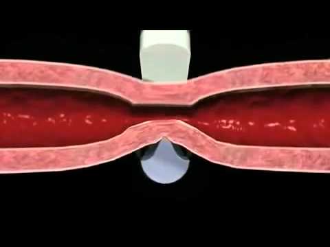 Torsional Ultrasound in Action