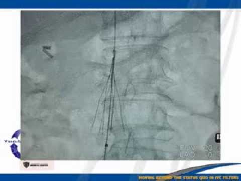 OptionELITE Over-The-Wire IVC Filter Delivery Technique