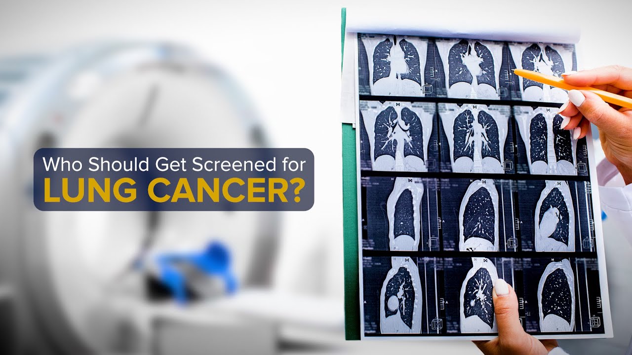 Who Should Get Screened for Lung Cancer?  Updated Federal Screening Guidelines Explained
