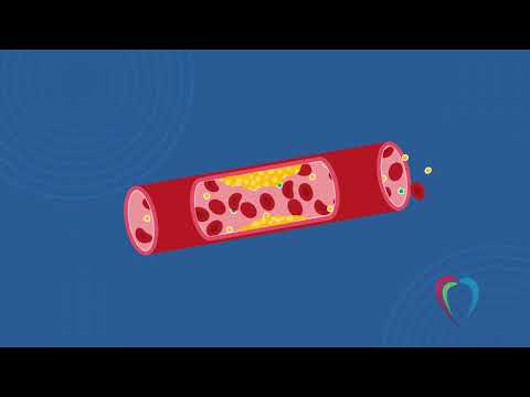 What is Coronary Artery Disease? Dr. David Prutzman | Biltmore Cardiology