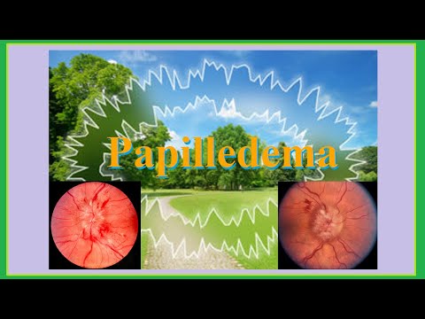 papilledema