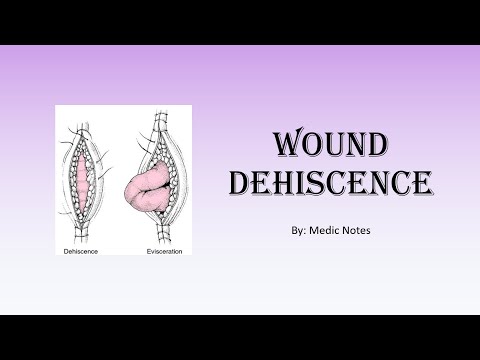 Wound dehiscence - risk factors, clinical features, investigation, management, prevention