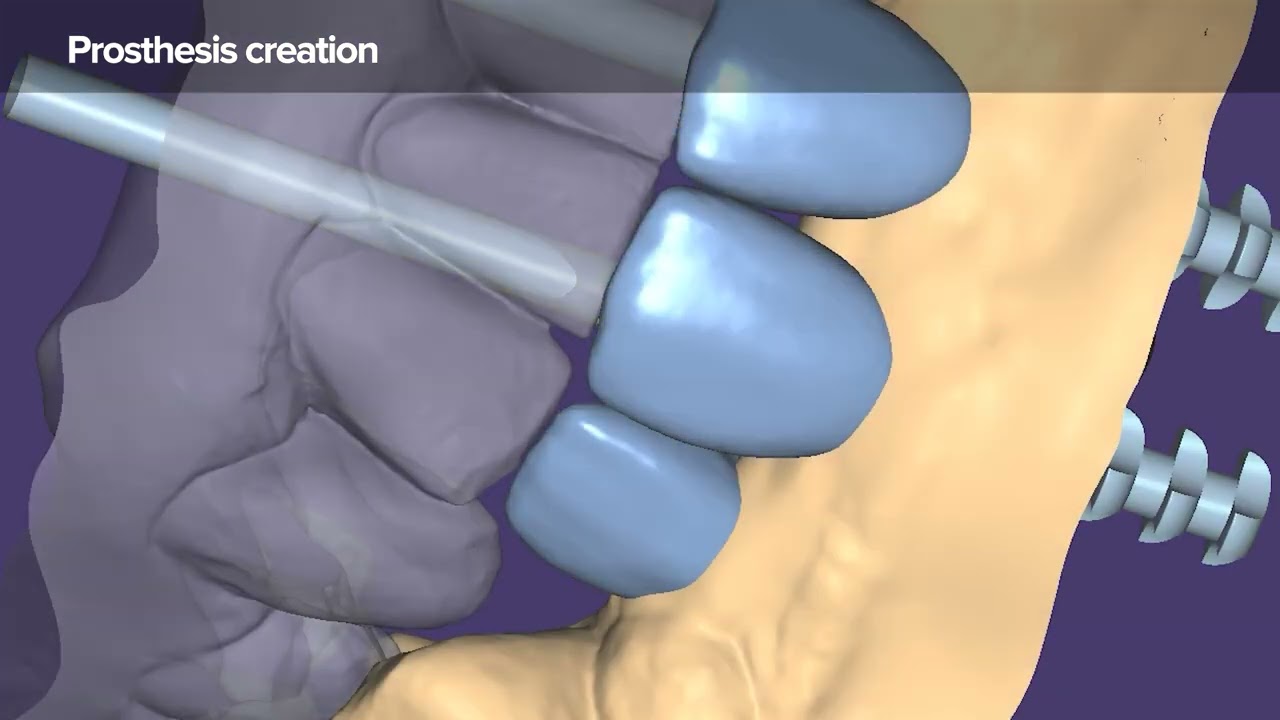 ROOTT Implant system Digital ready
