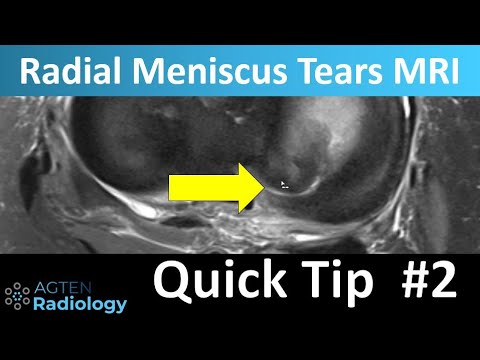 Spotting Radial Meniscus Tears on MRI (MSK Quick Tip)