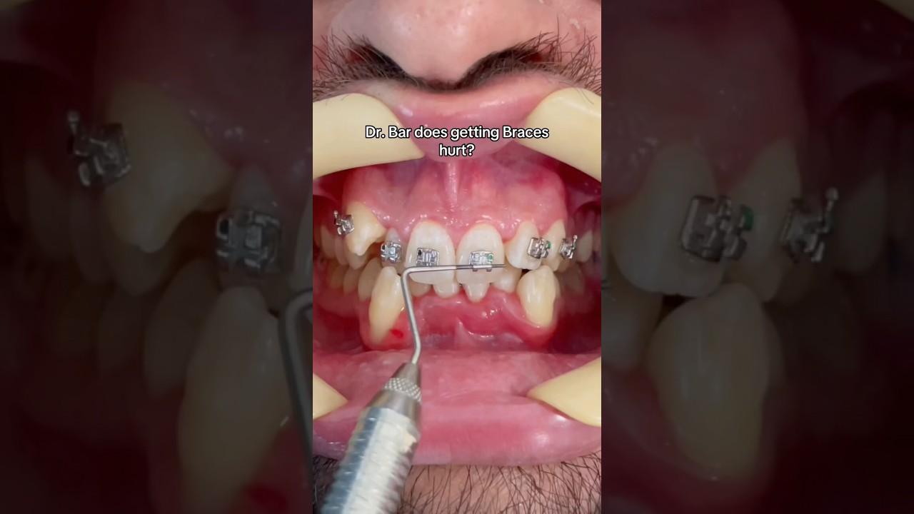Does Getting Braces Hurt? Here's the Truth!