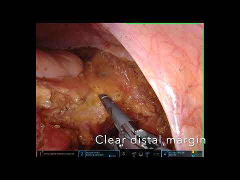 Robotic low anterior resection (LAR) (ICG in nodes)