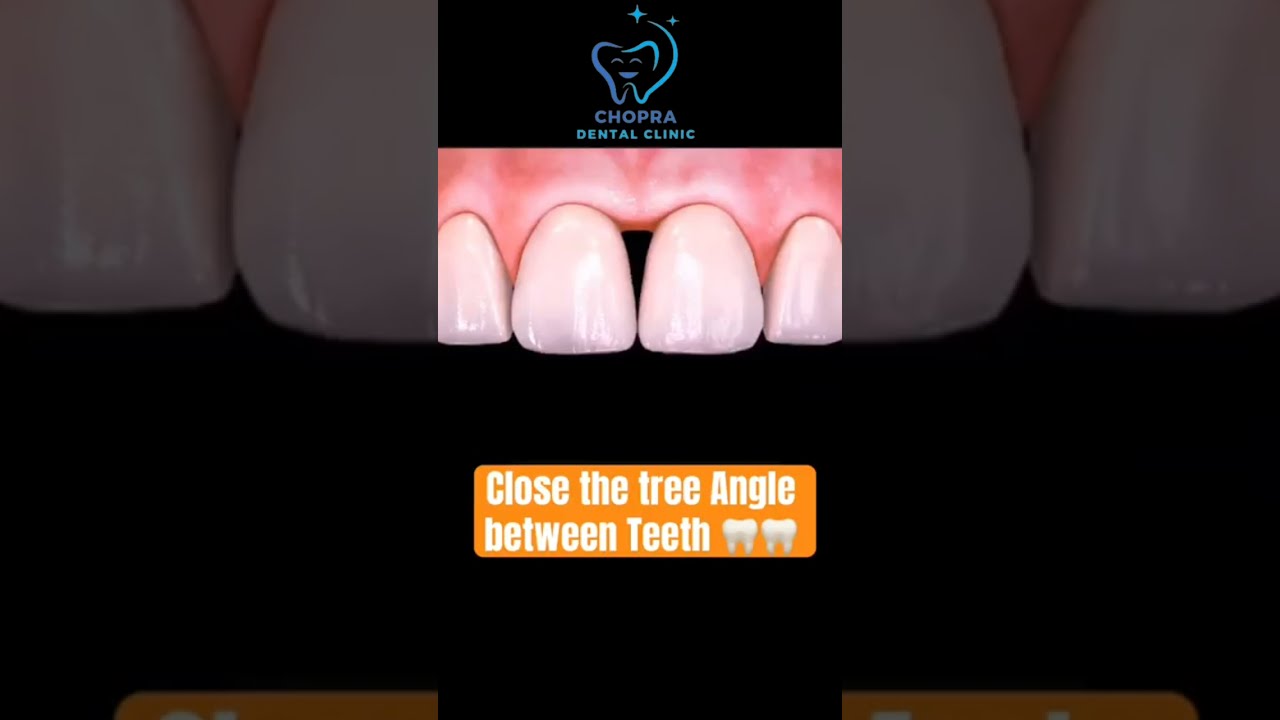 Close the tree angle between teeth