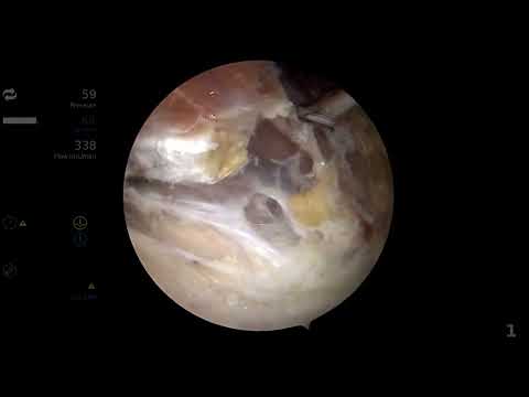 Endoscopic Piriformis Release and Sciatic Neurolysis