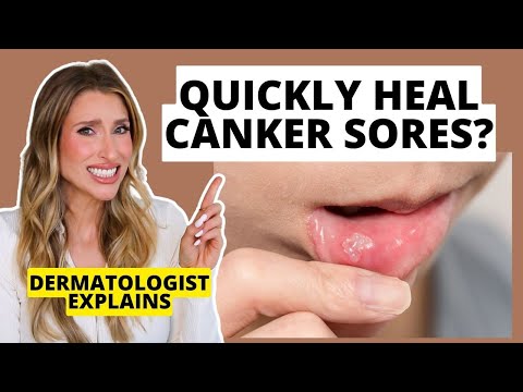 Quickly Heal Canker Sores: How to Prevent & Heal Them Faster | Dermatologist Explains