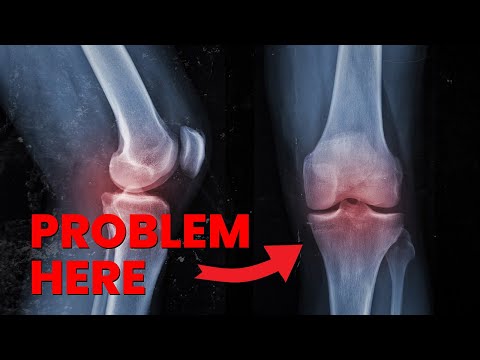 KNEE PAIN leads to a SHOCKING DIAGNOSIS
