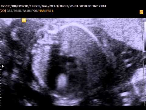 Tuberous sclerosis fetal heart tumour
