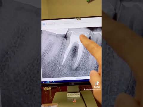 Endodontic retx of tooth #30 through a crown in 1 visit. Endo/perio!